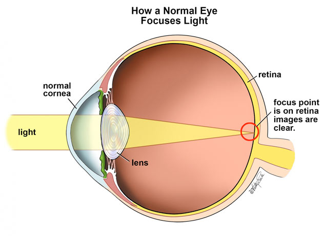 What Is Custom Lasik What Is Custom Lasik